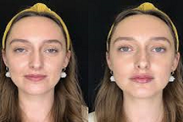 Fillers Injection 3
