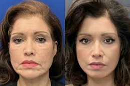 Facial Reconstruction Surgery 5