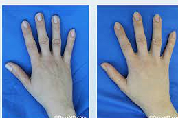 Hand Rejuvenation 3