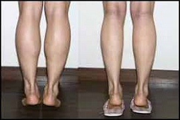 Calf Reduction 5